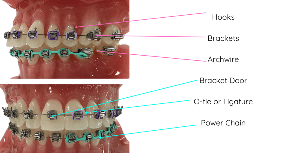 Braces Wire Pokey, What to Do?